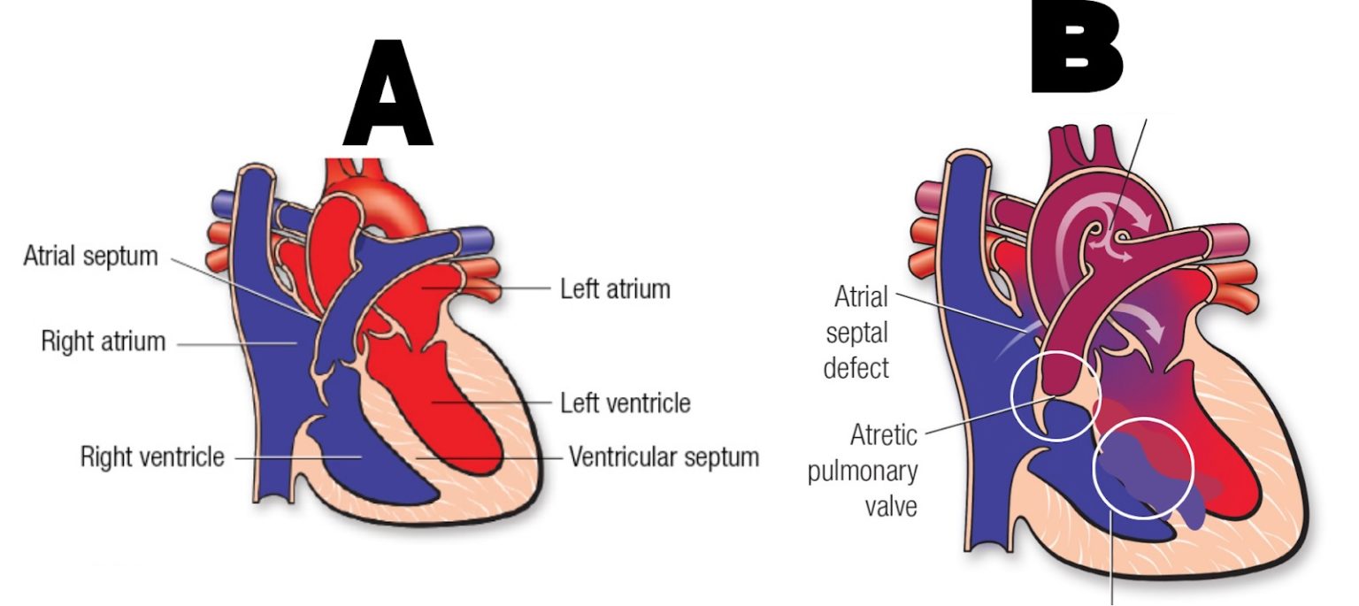 Single Ventricle Heart Disease - Love Them All